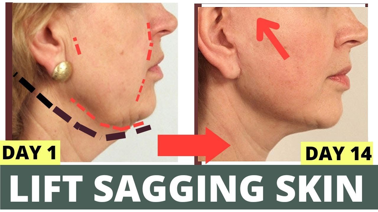 Lift Sagging Skin Exercise Reduce Nasolabial Folds Marionette Lines
