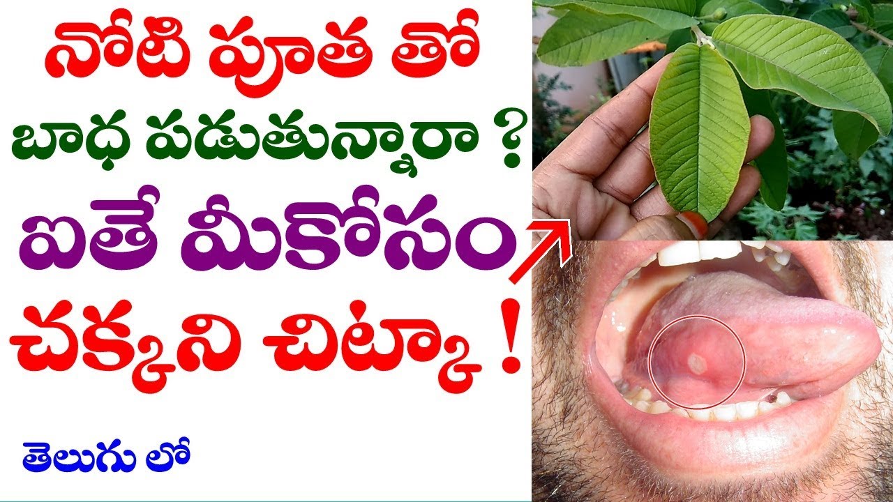 నోటిపూత తో బాధపడుతున్నారా ? ఐతే మీకోసం చక్కని చిట్కా ! || noti pootha ...