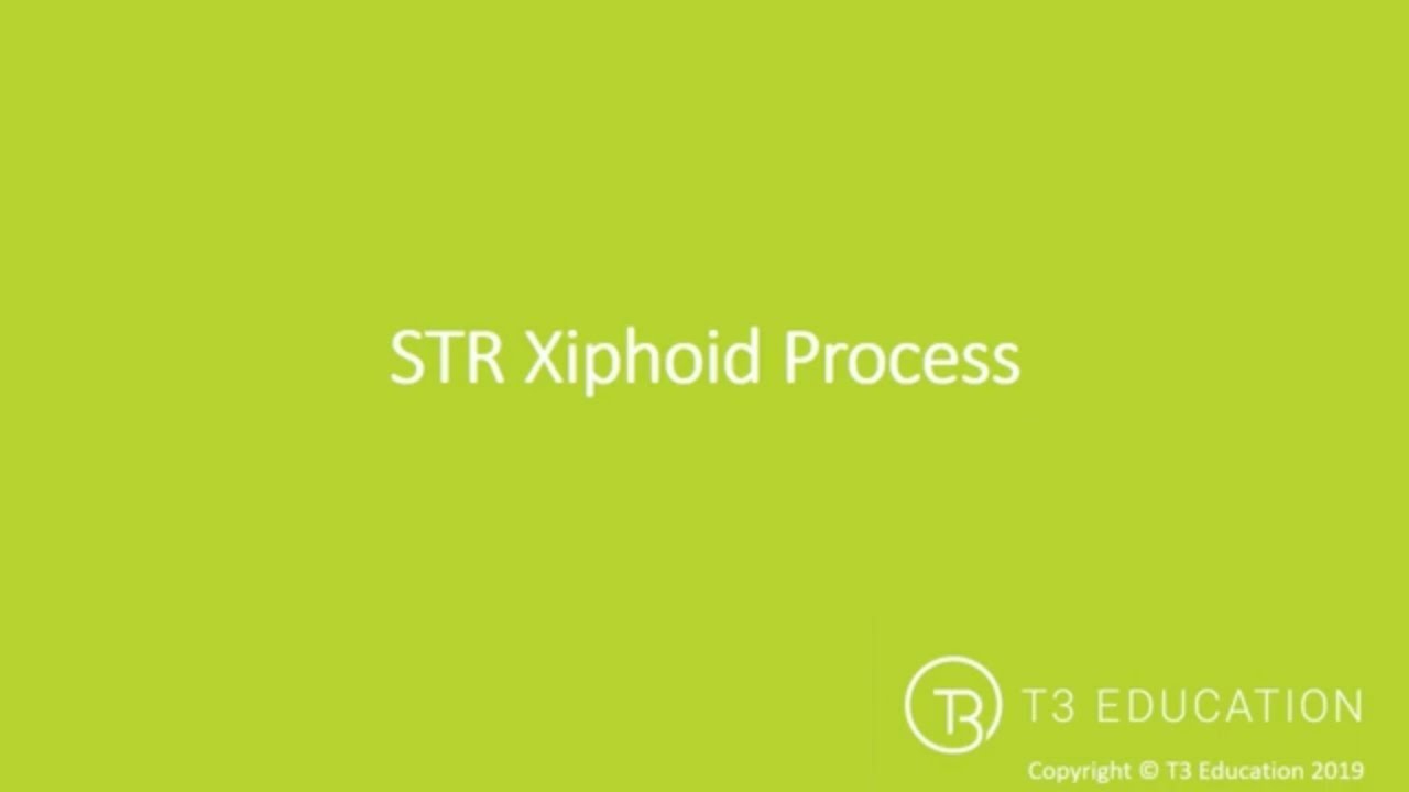Xiphoid Process Pain Xiphoidalgia The Ultimate Guide An Unusual Case