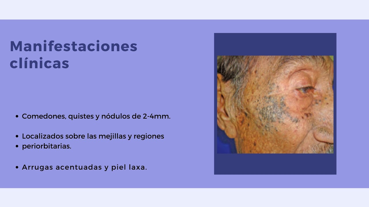 Síndrome de Favre Racouchot - YouTube