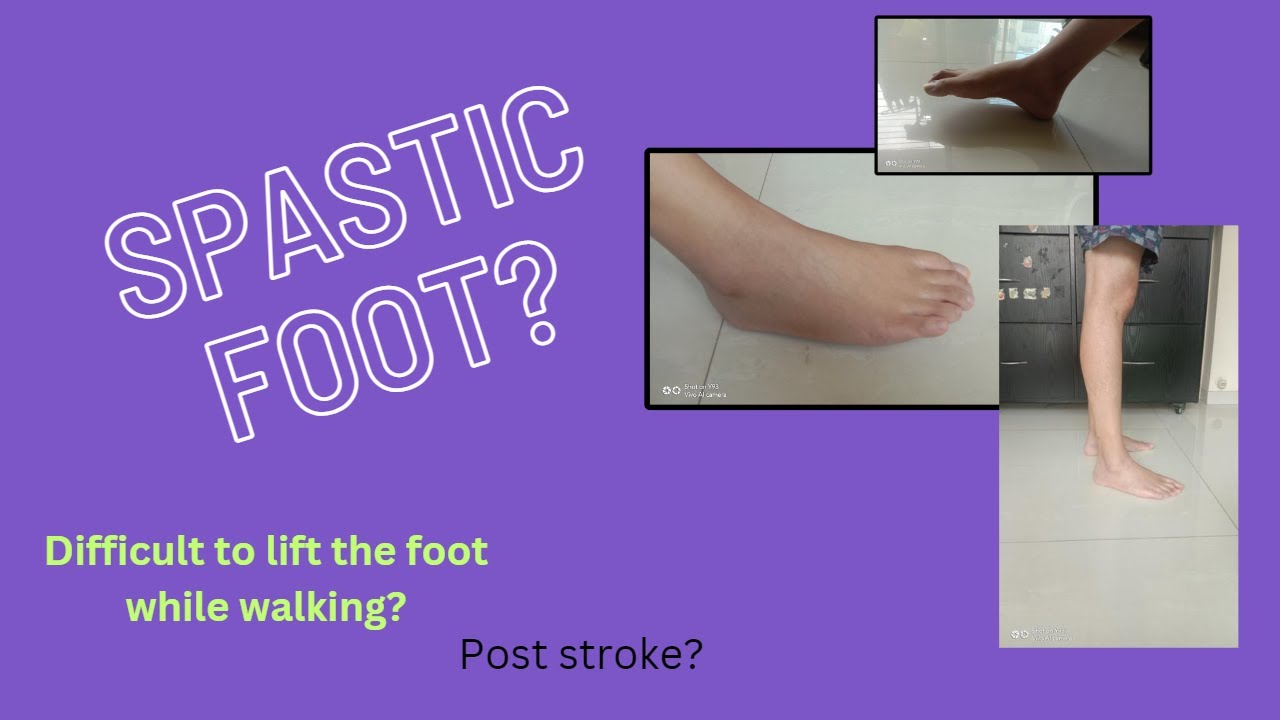 SPASTIC FOOT?/LIFTING FOOT IS DIFFICULT?/ WALKING WITH FOOT DROP? - YouTube