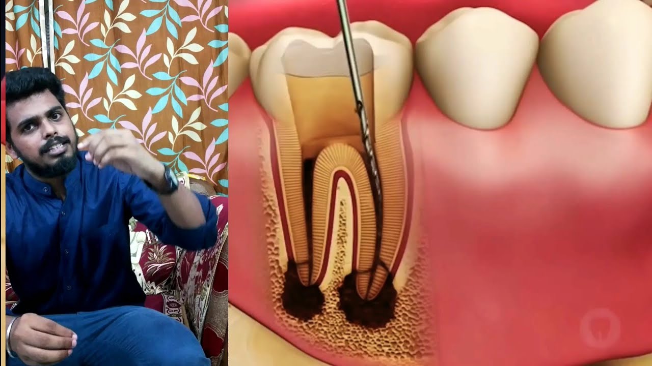 RCT in hindi| what is RCT | root canal treatment? | RCT step by step ...