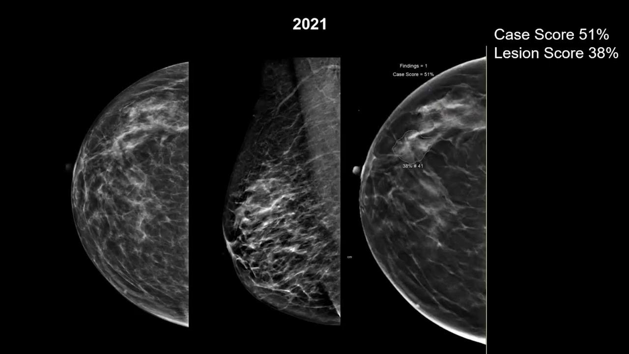 ProFound AI detects breast cancer two years before doctors - YouTube