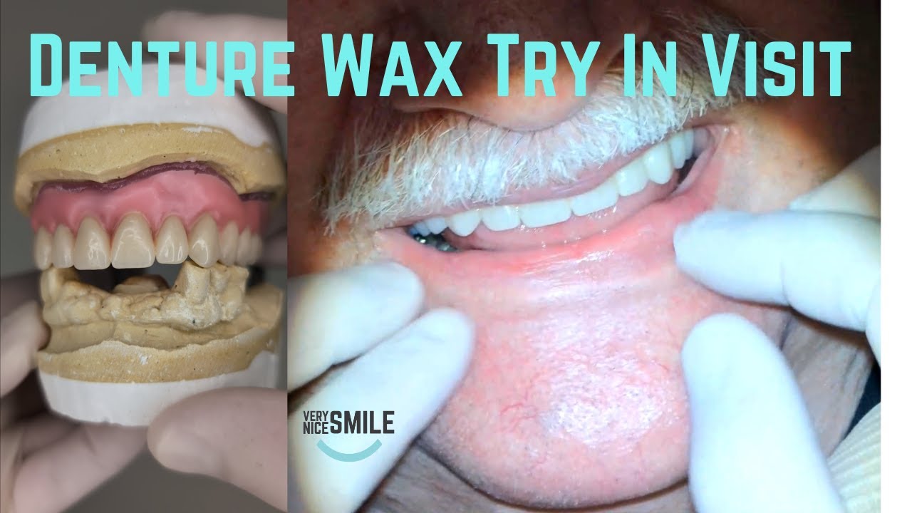 Denture Wax tryin Visit - YouTube