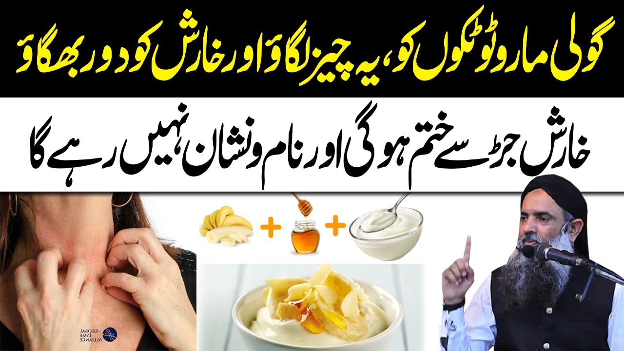 Kharish Ka elaj | Itching Treatment at Home by Dr Sharafat Ali | Health ...