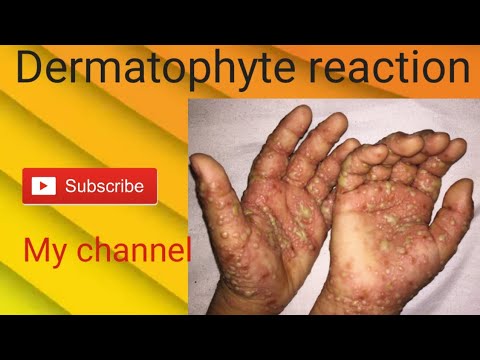 skin reaction (dermatophytide reaction) - YouTube