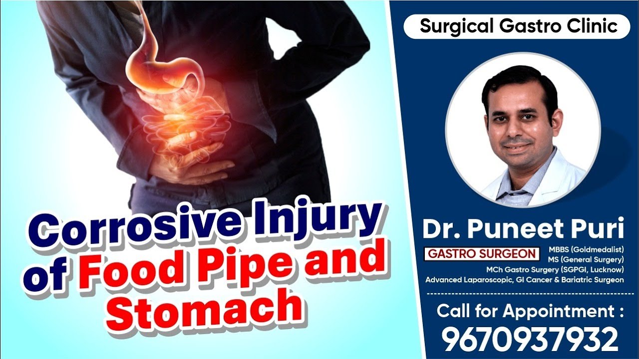 Corrosive Injury of Food Pipe & Stomach | एसिड पीने से खाने की नली और ...