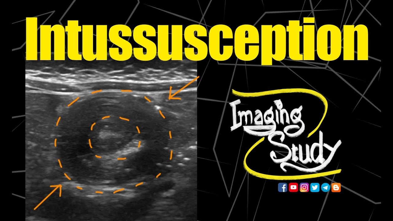 Intussusception || Ultrasound || Case 154 - YouTube