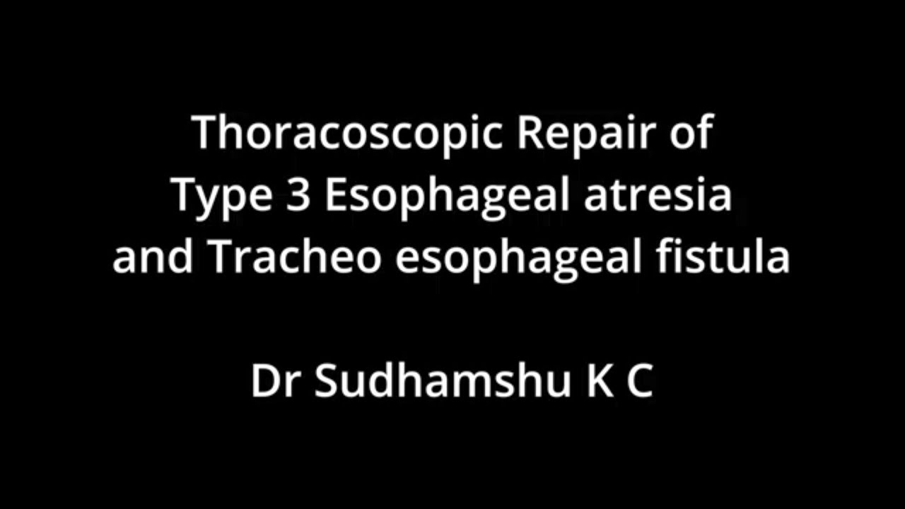 Tracheo esophageal fistula - Thoracoscopic TEF repair - YouTube