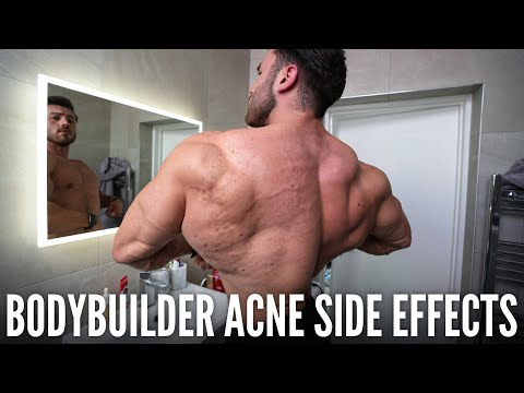 DEALING WITH ACNE AS A BODYBUILDER SIDE-EFFECTS… - YouTube