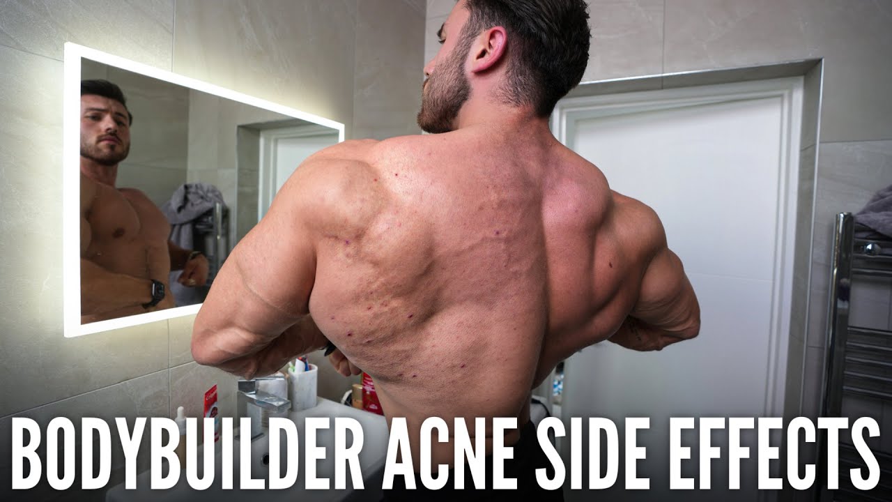 DEALING WITH ACNE AS A BODYBUILDER SIDE-EFFECTS… - YouTube