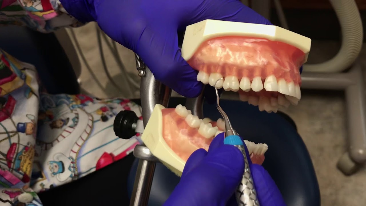 15/16 Posterior Gracey Demo - YouTube