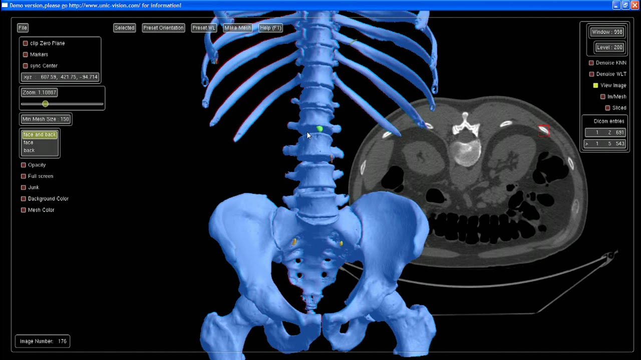 anaglyph 3d colon and skelet wmv (www.vi3dim.com) - YouTube
