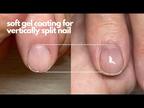 How To Repair Vertical Split Toenail