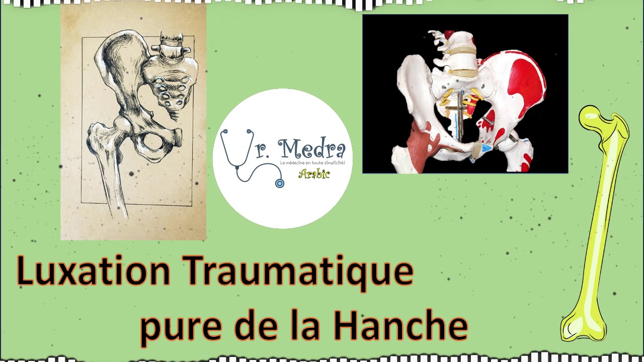 Luxation traumatique pure de la hanche🦵🦴 - Arabic - YouTube