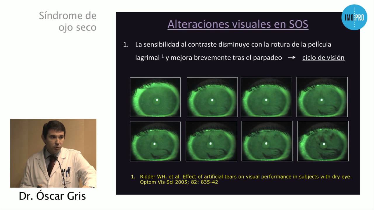 Síndrome del ojo seco, la patología oftalmológica más frecuente (Dr ...