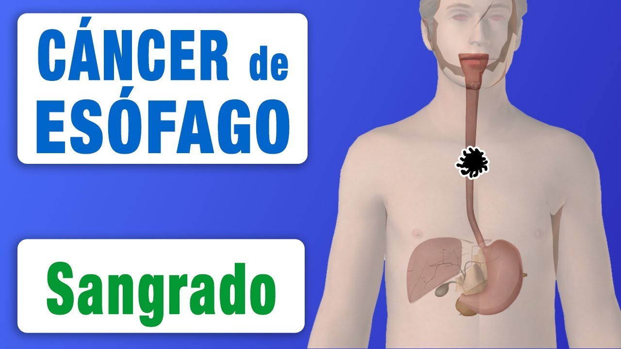 Síntomas del cáncer de esófago - Sangrado - YouTube