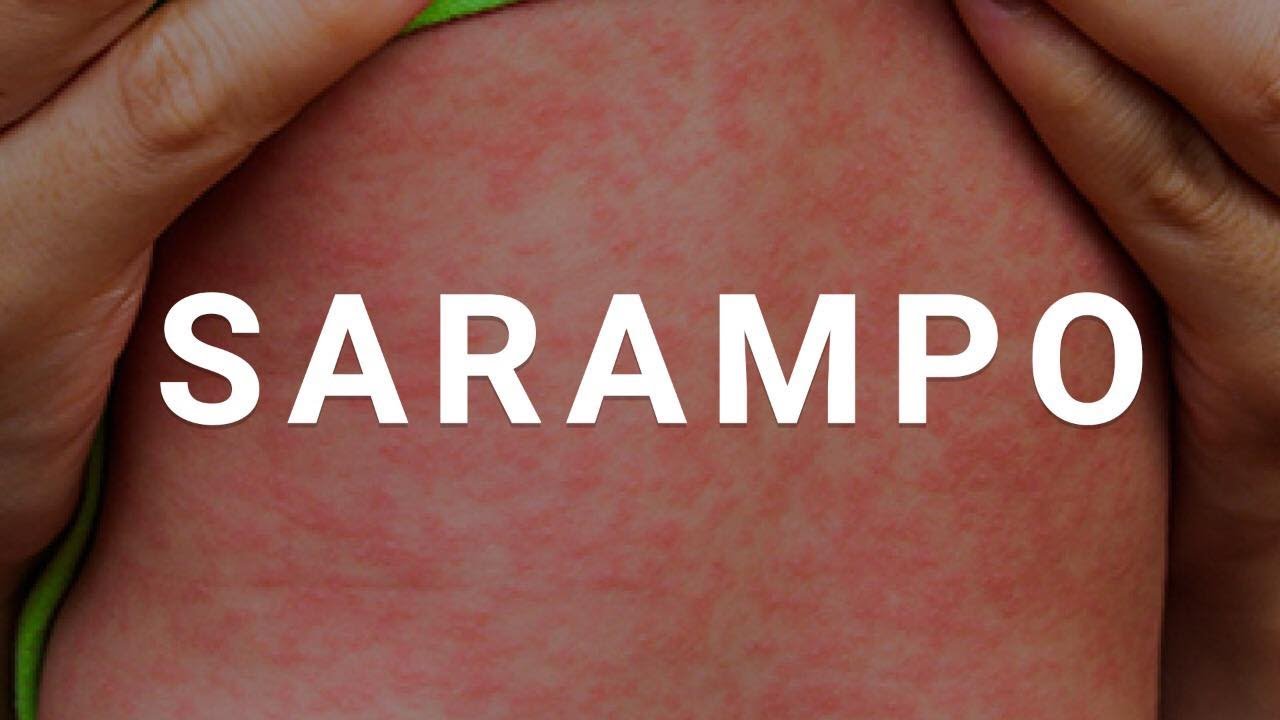 SARAMPO - YouTube