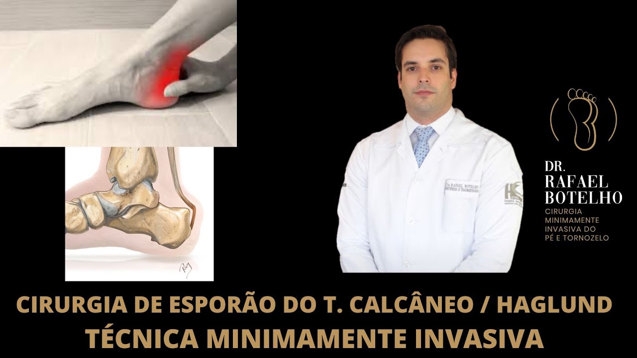 Cirurgia de Esporão do Tendão Calcâneo / Síndrome de Haglund - TÉCNICA ...