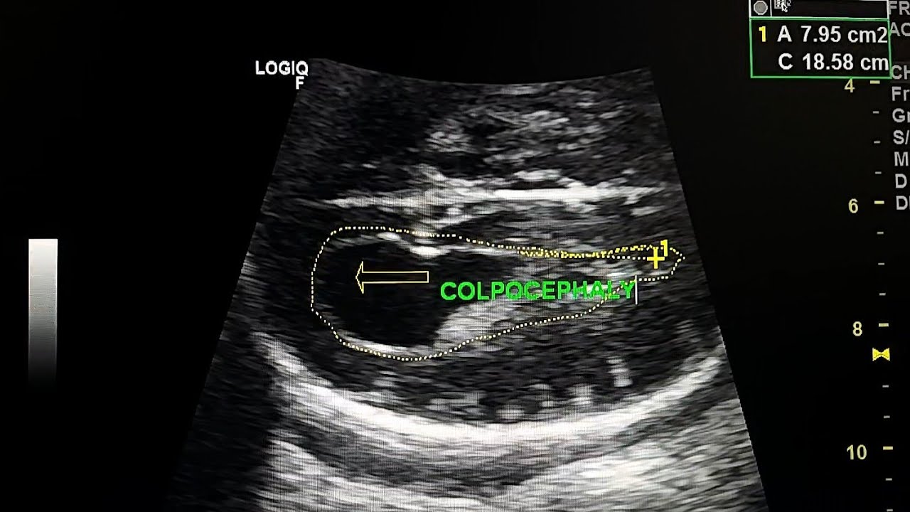 ultrasound case - Dysgenesis or agenesis of the corpus callosum - YouTube