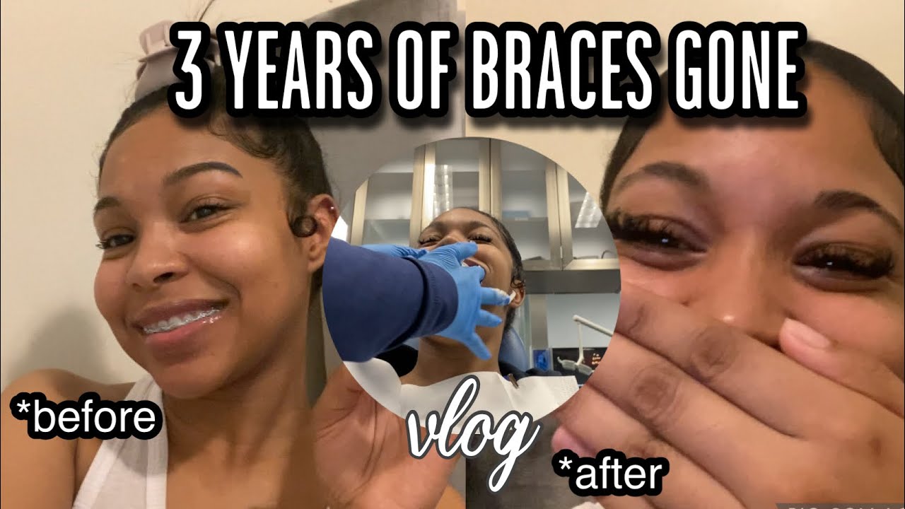 DAILY VLOG: GETTING MY BRACES OFF AFTER 3 YEARS 😩 ️ - YouTube