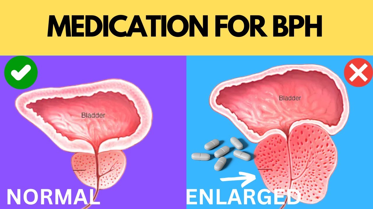 Benign Prostatic Hyperplasia (BPH) - Medications like tamsulosin and ...