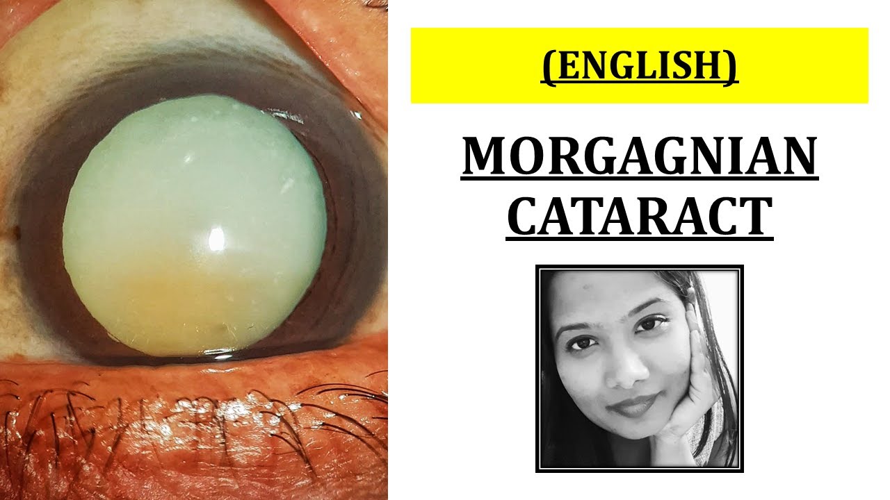 What is a 'Morgagnian Cataract'? | Ophthalmology - YouTube