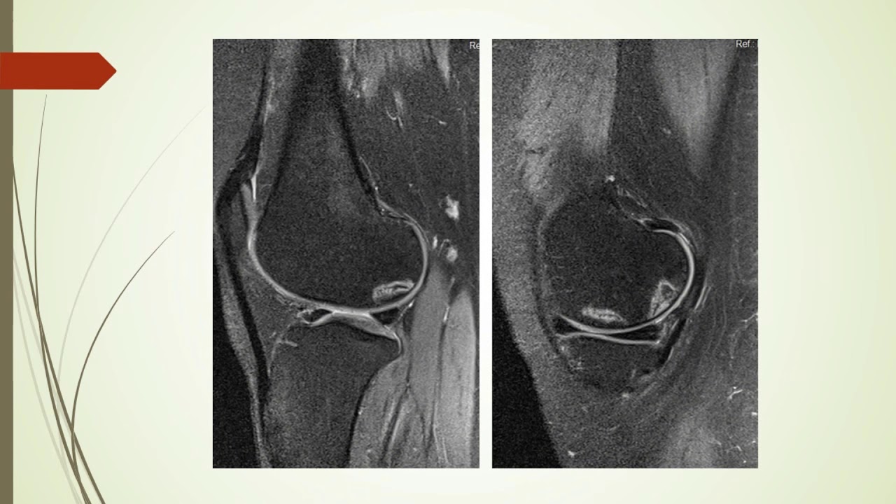 Osteonecrosis de Rodillas. RM de Rodillas. - YouTube