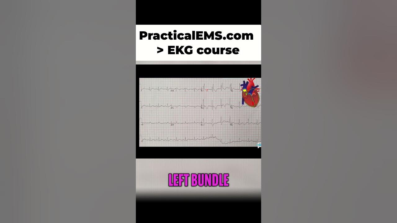 Right Bundle Branch Block: ECG Interpretation Made Easy - YouTube