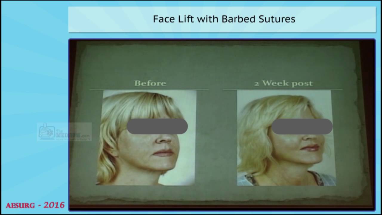 Face Lift with Barbed Sutures - YouTube
