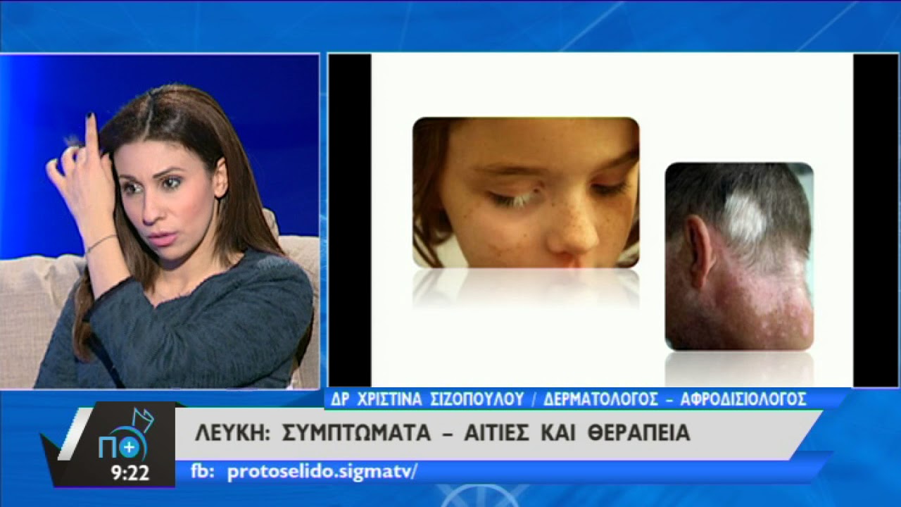 ΤΙ ΕΙΝΑΙ Η ΛΕΥΚΗ ΣΤΟ ΔΕΡΜΑ ΚΑΙ ΠΩΣ ΑΝΤΙΜΕΤΩΠΙΖΕΤΑΙ - YouTube