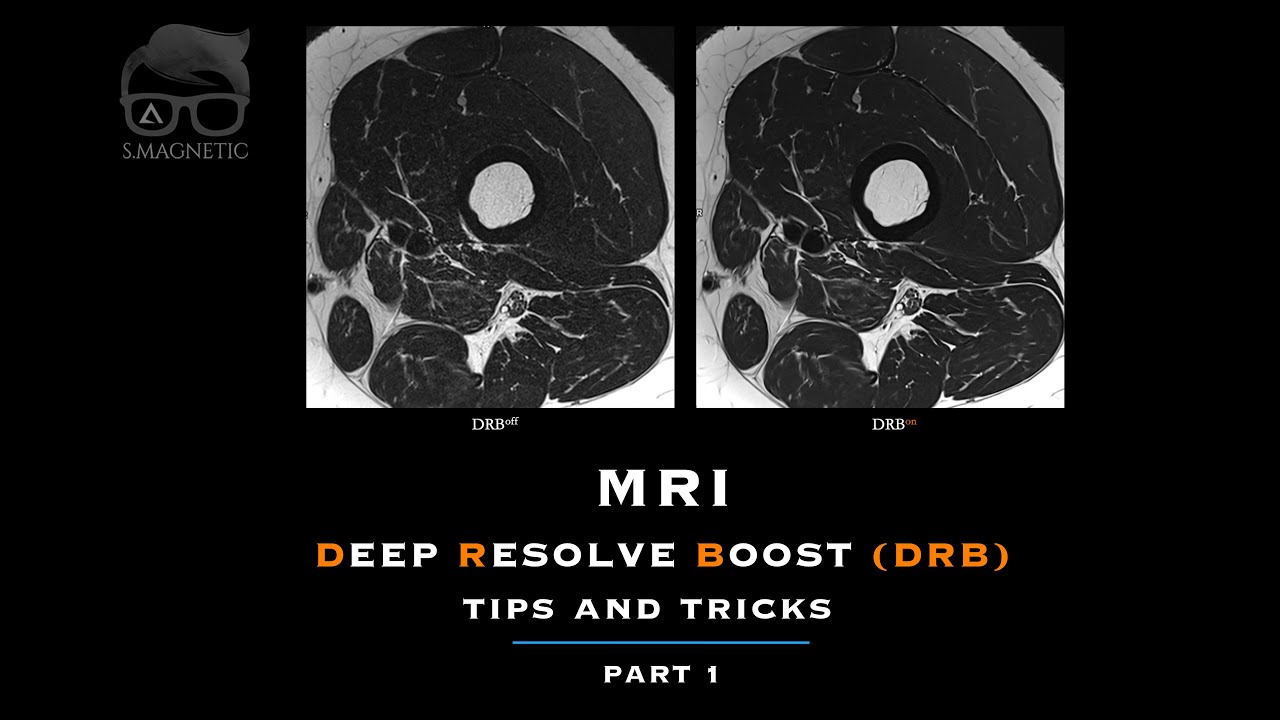 MRI DEEP RESOLVE BOOST (DRB) – TIPS & TRICKS - YouTube