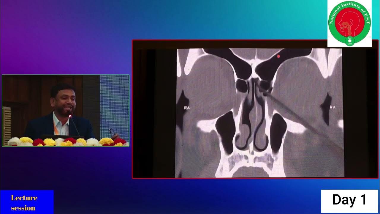 How Surgeons Read CT Scan of Nose & PNS: Prof. Ashequr Rahman: 8th Int Endoscopic & Skull Base ...