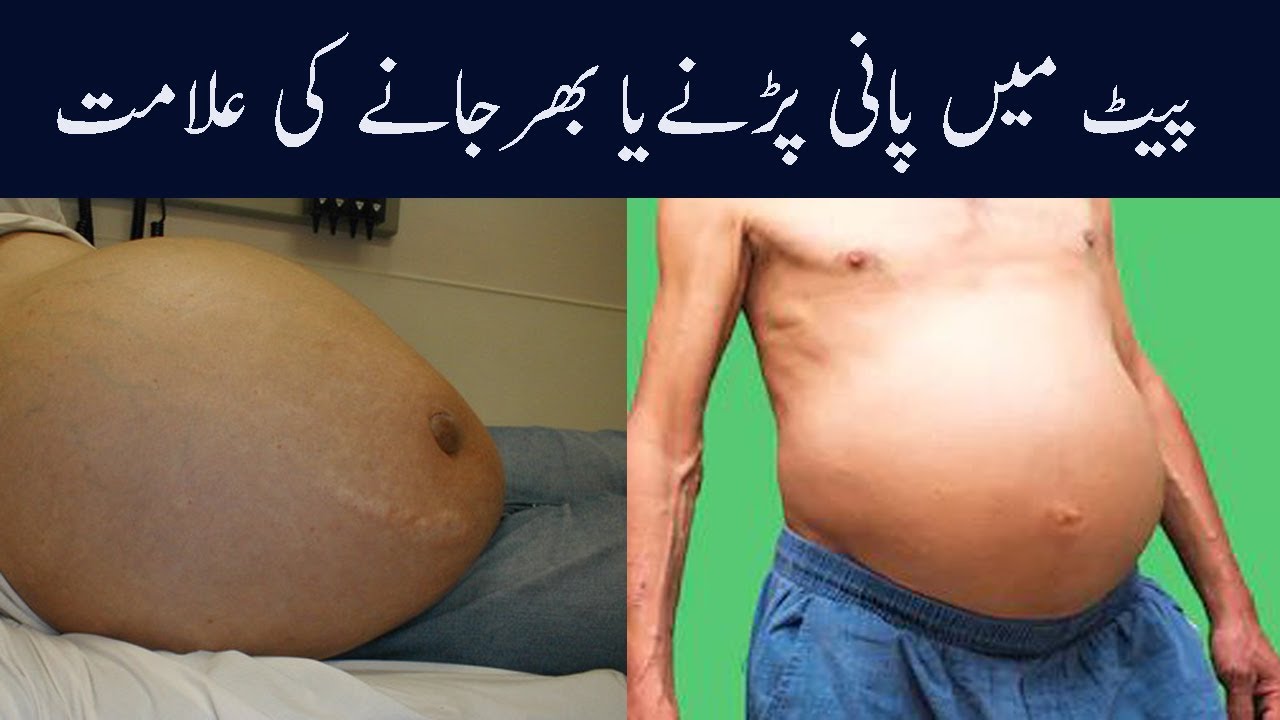 Ascites Symptoms In Urdu Pait Me Pani Bharne Ki 8 Alamat YouTube ascites-symptoms-in-urdu-pait-me-pani-bharne-ki-8-alamat-youtube