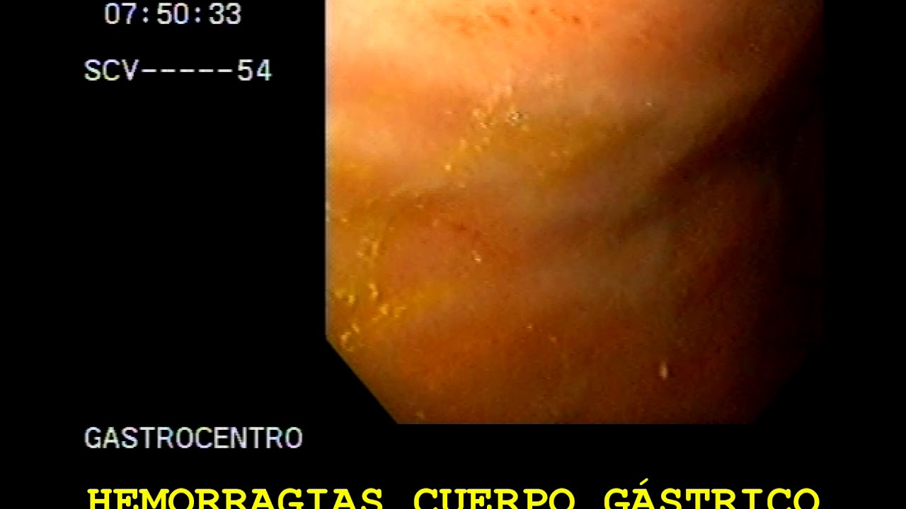 Tumor de Esófago y Cardias - YouTube