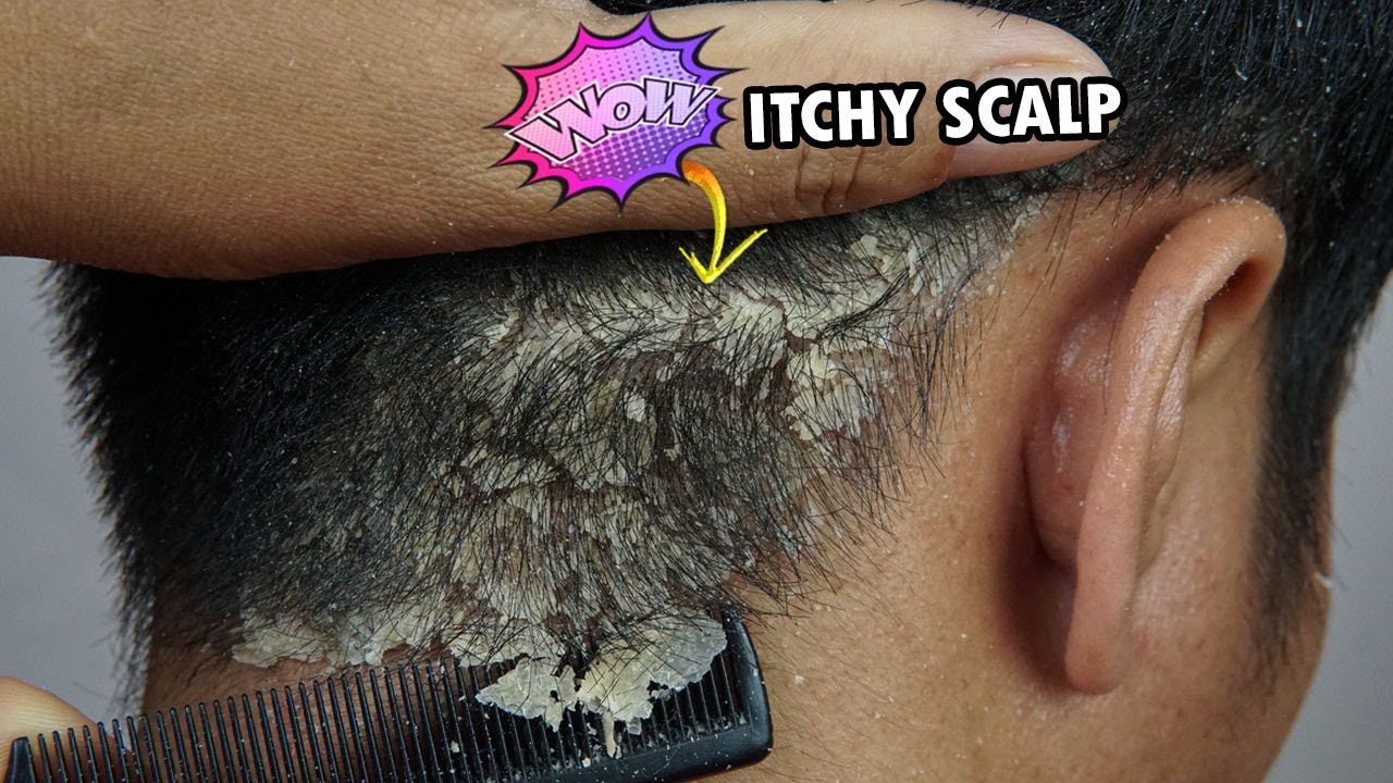 Best Of The Itchy Scalp!! Dandruff Flakes Scratching #518 - YouTube
