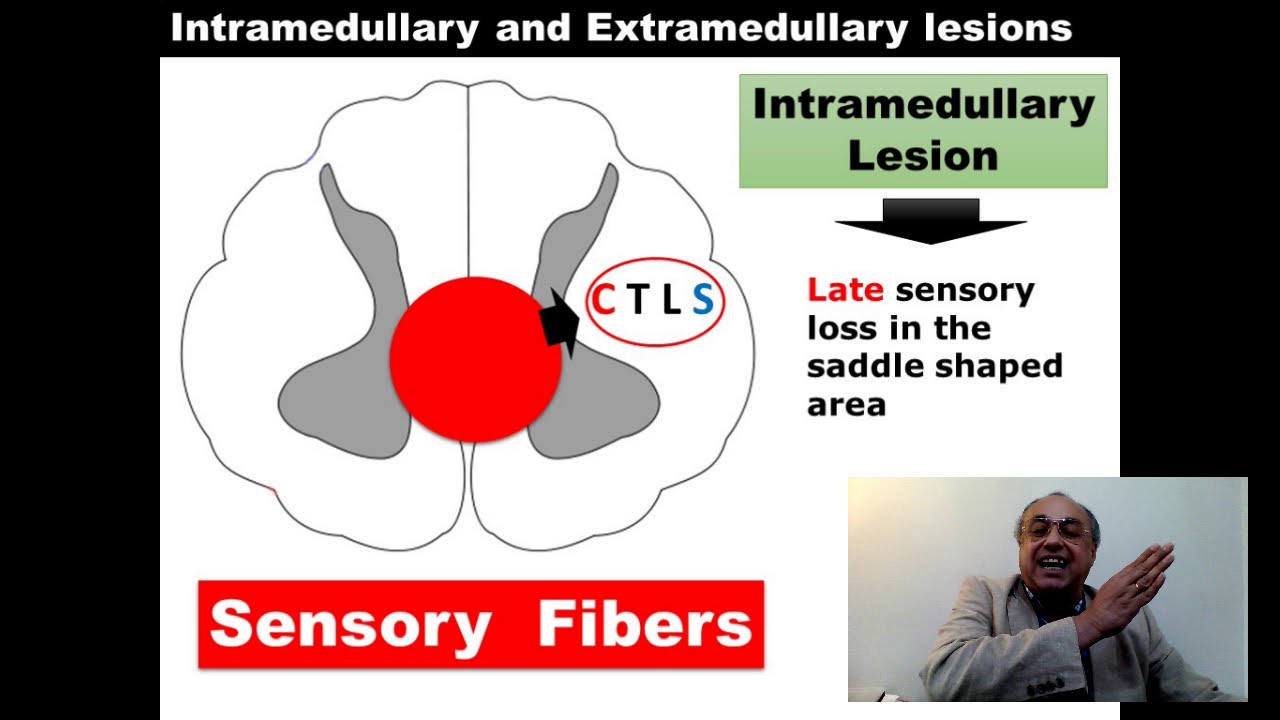 Difference Between Intramedullary and Extramedullary lesions (Neurology ...