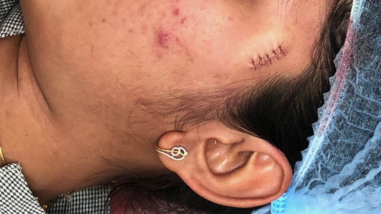 Elliptical excision of compound nevus. - YouTube