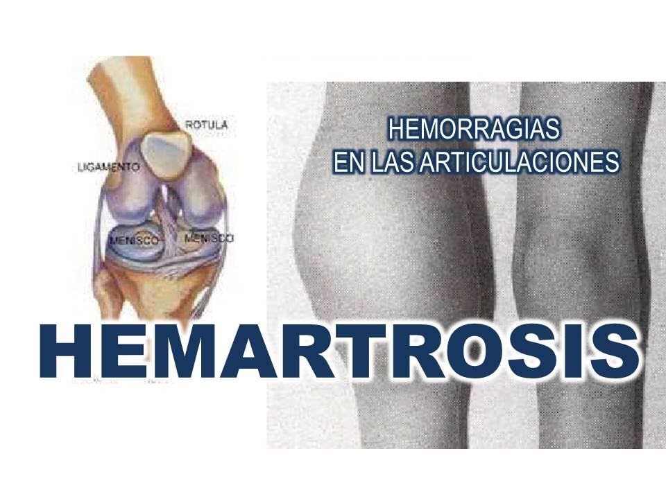 HEMARTROSIS - HEMORRAGIAS EN UNA ARTICULACIÓN - YouTube