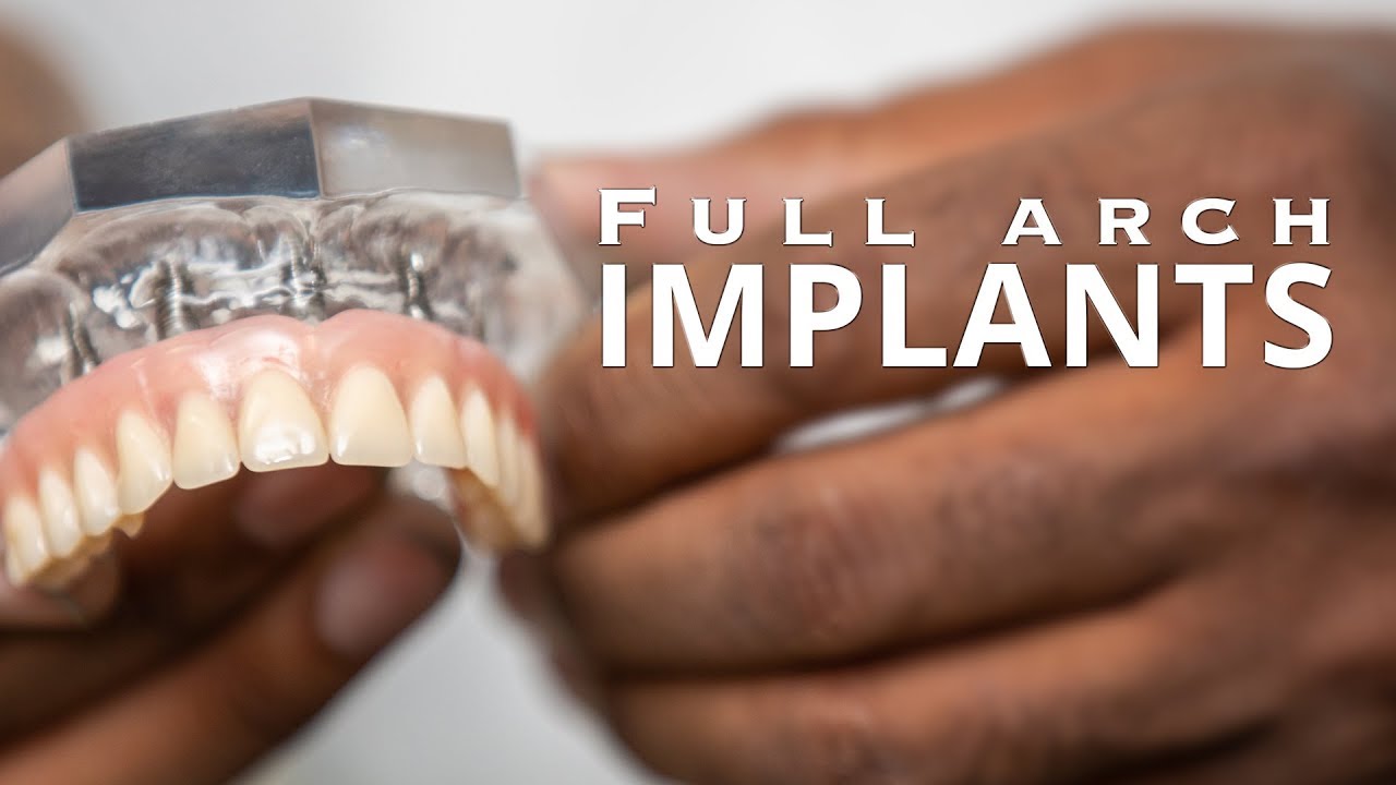 Full arch dental implants gave me a permanent solution to my ...