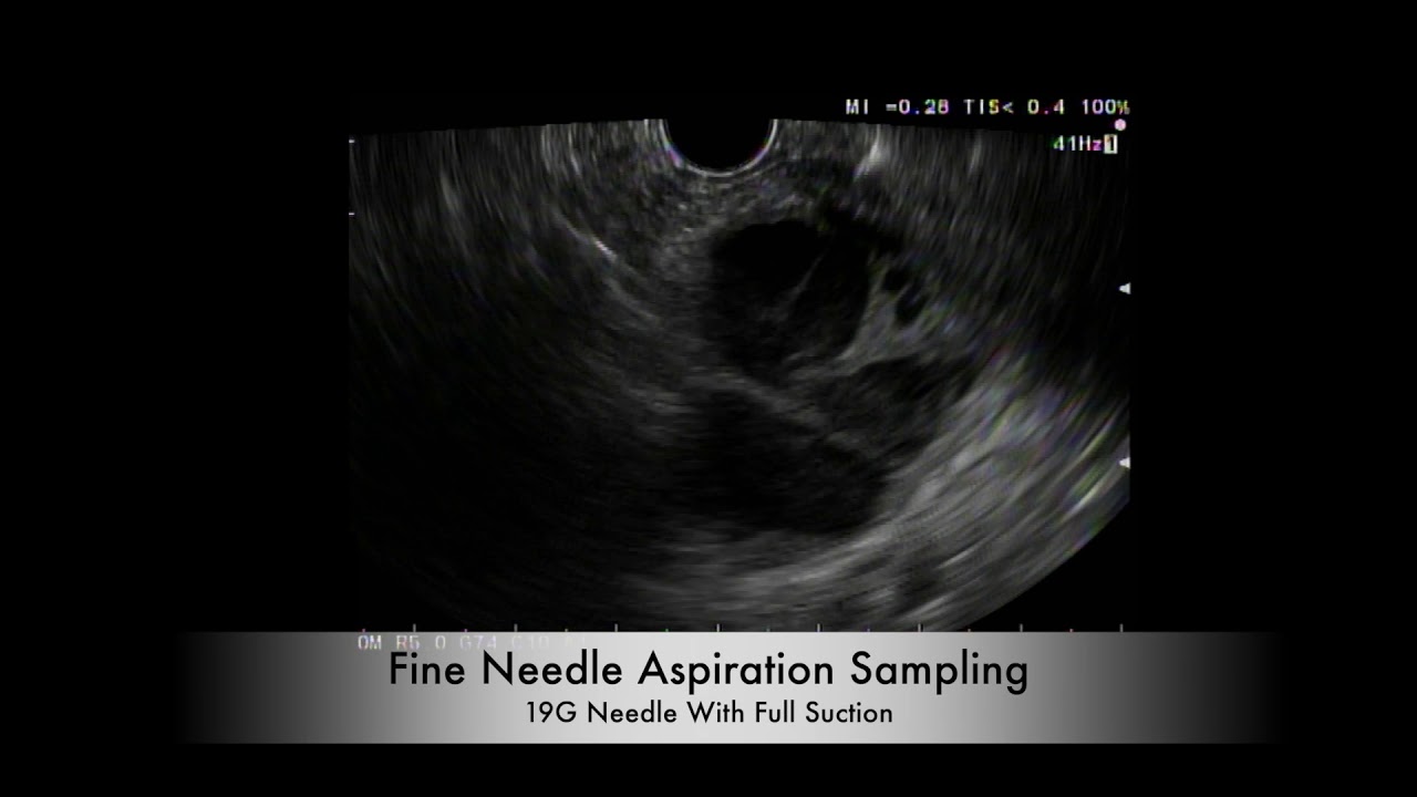 Complex Uncinate Pancreas Cyst on EUS - YouTube