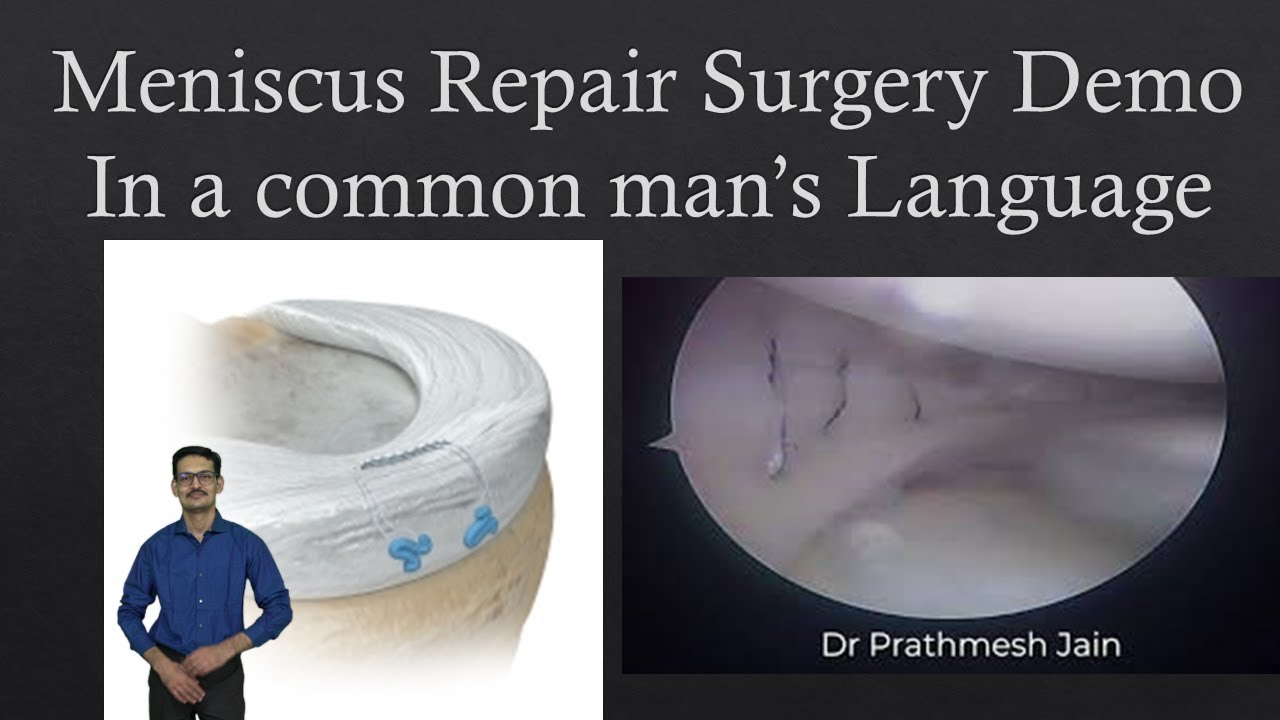 Inside Out Meniscal Repair The Gold Standard Meniscus Repair Surgical ...