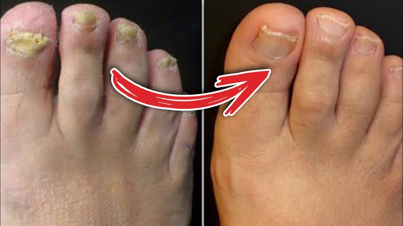 USE THIS NOW AND DESTROY FOOT FUNGI ONCE AND FOR ALL! Foot Fungus ...