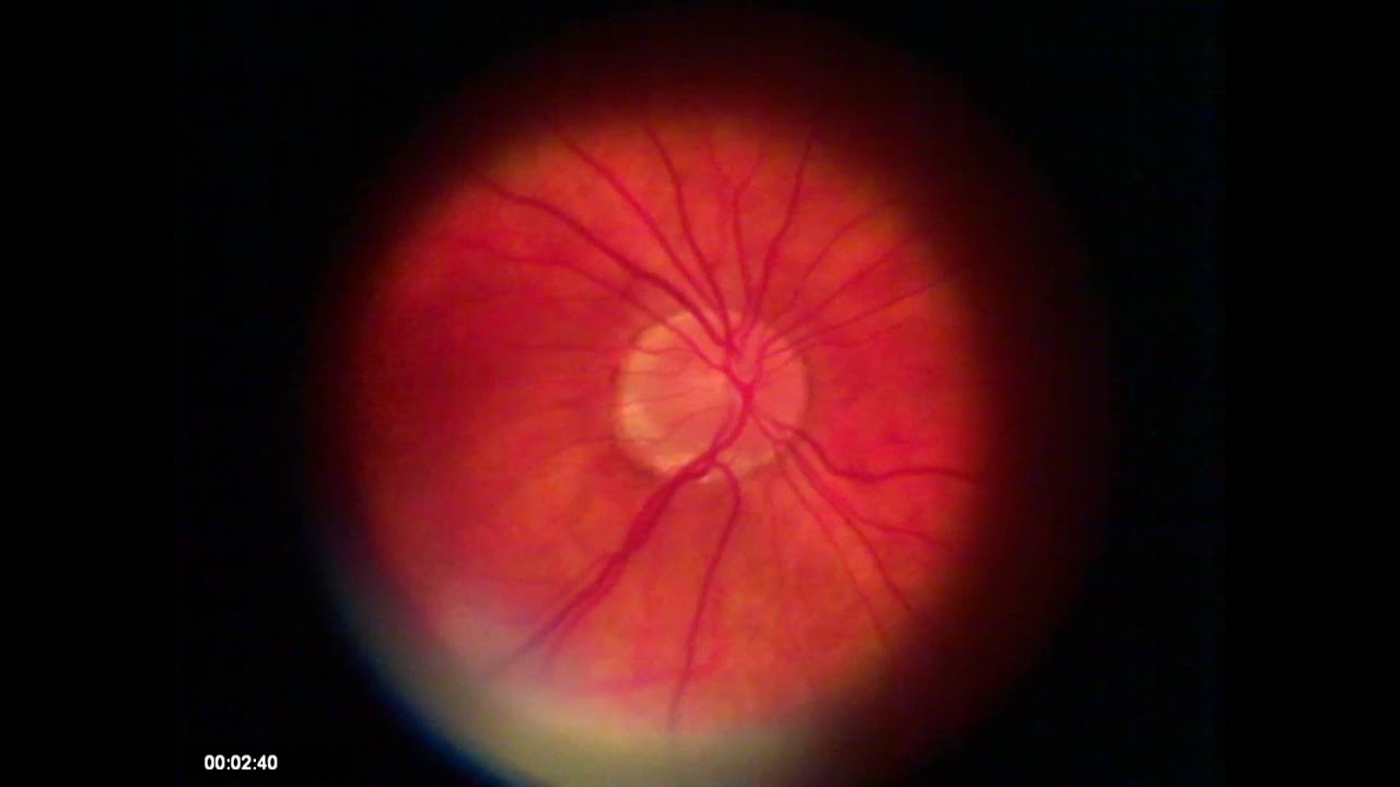 Video Clip of the Optic Nerve and Retina using Provizion's Panoptic ...