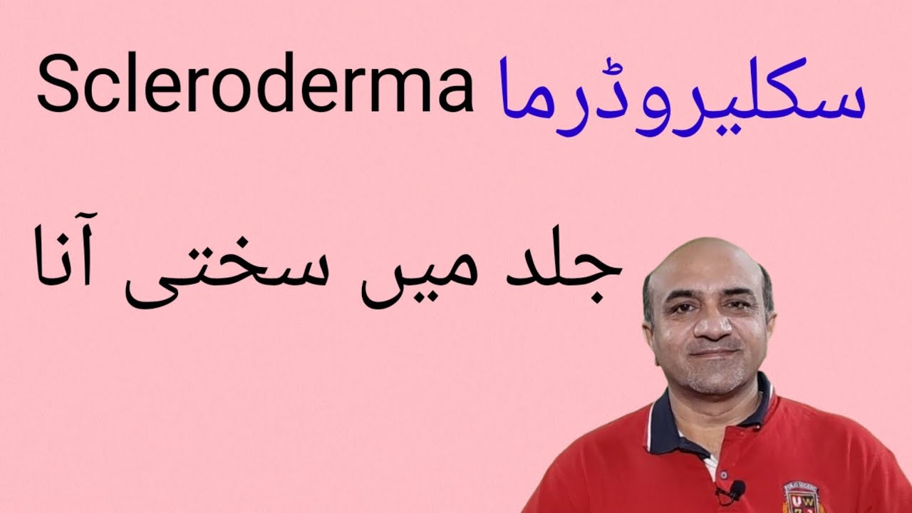 Scleroderma | What Is Scleroderma,Diagnosis & Management - YouTube