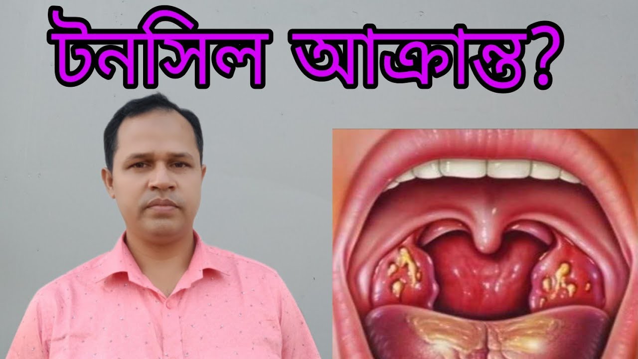 Ways to keep Tonsils healthy টনসিল সুস্থ রাখার উপায় - YouTube