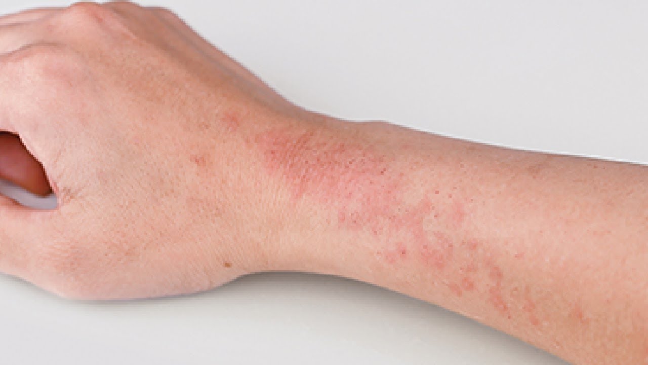 How To Get Rid Of Itchy Skin At Night YouTube how-to-get-rid-of-itchy-skin-at-night-youtube