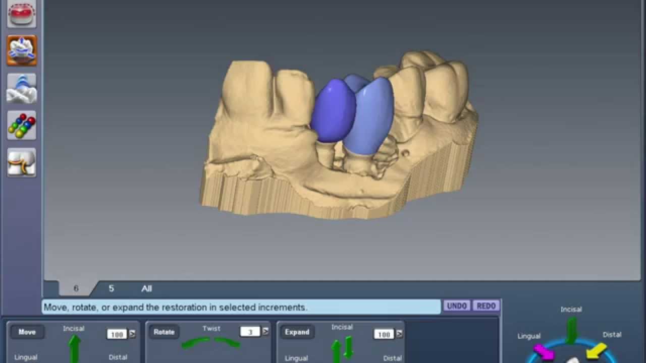 E4D eMax PlanScan 5 - Advanced Implant Crown Design – Applying Clone ...