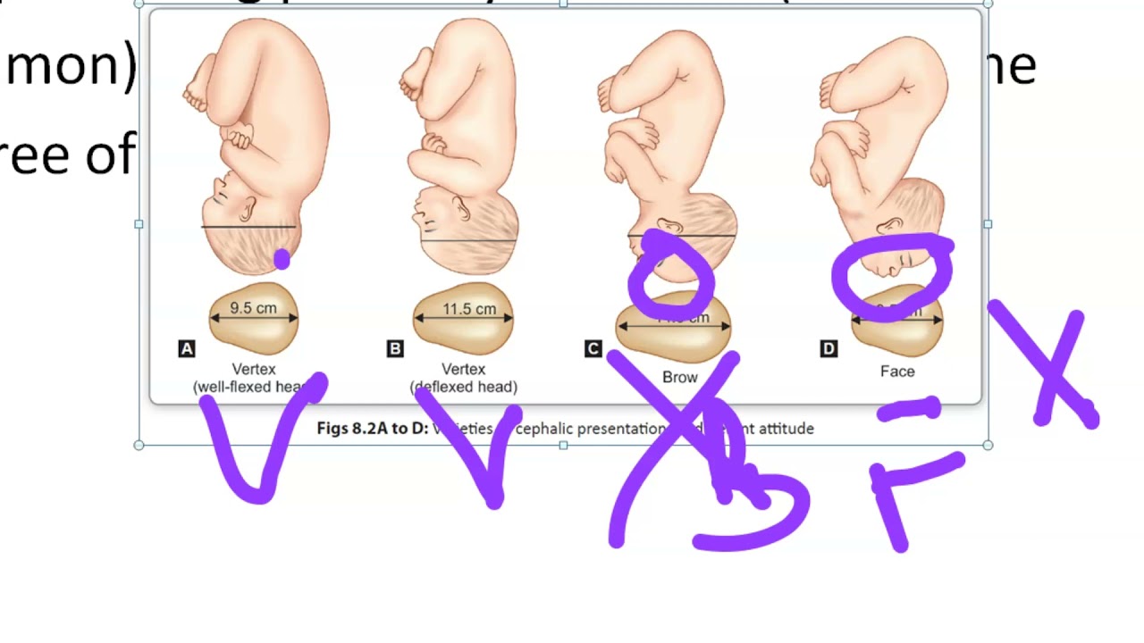 Obsetrics 110 Fetal Presentation Presenting Part Position Difference Obsetrics 110 Fetal Presentation Presenting Part Position Difference