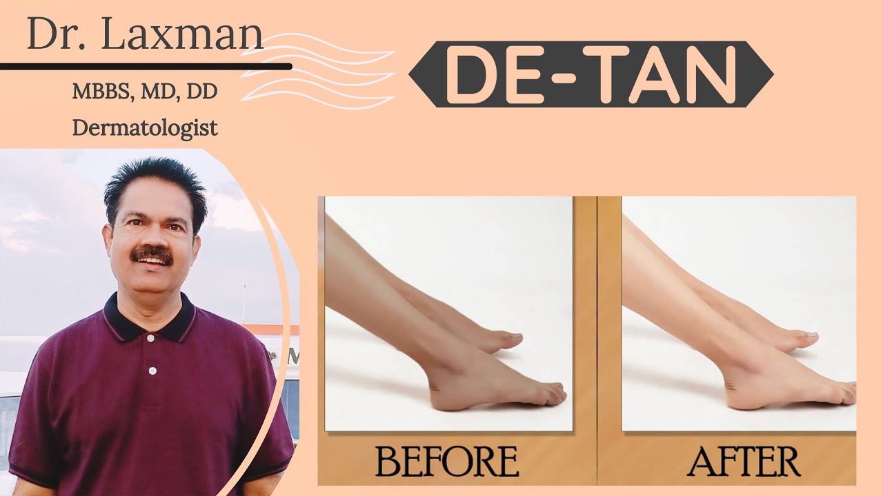 De-Tan - Cause & Treatment | Remove Tan | Sun Tan Removal | Skin ...